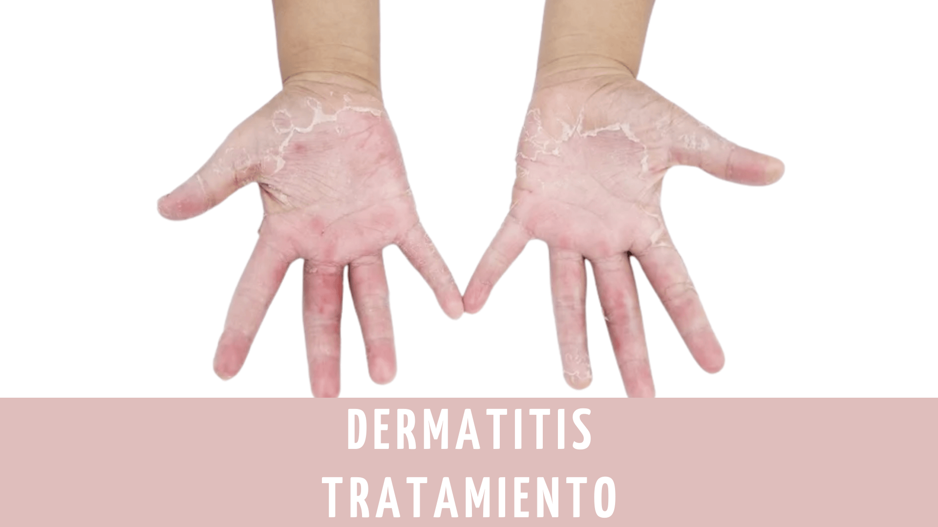 Crema para la Dermatitis| Piel Seca - Sensible – Luce Skincare